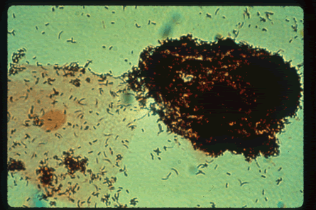 Bacterial Vaginosis Versus Yeast Infection – antoniooqnbkixi's Blog